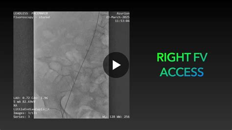 Leadlesspacemaker Angiogram Transjugular Cardiology Hearthealth