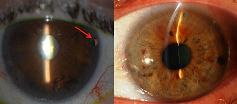 Glaucoma Information Laser Peripheral Iridotomy Glaucoma Information