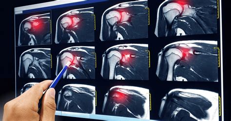 Rotator Cuff Problems How To Prevent Them Resilience RX