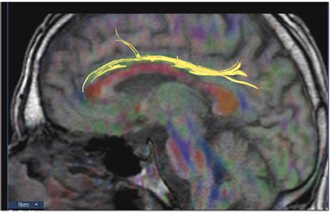 Sagittal Fa Color Map Overlaid On T1wi Tractography Of The Cingulum Download Scientific