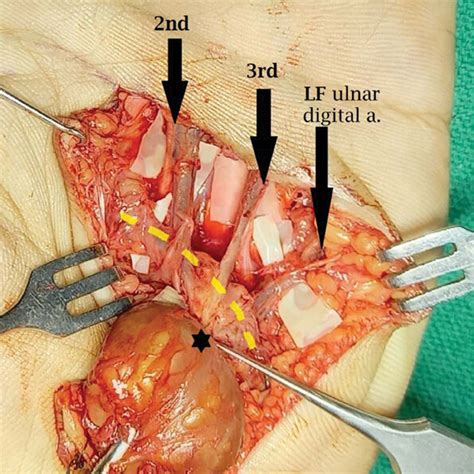 The Smaller Pseudoaneurysm Arrow Exposed After Resection Of The