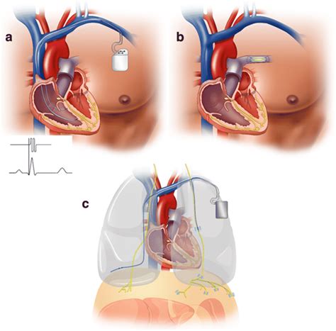 Novel Devices For The Management Of Hf And Csa A Cardiac Contractility