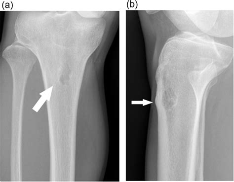 Tibial Cortical Lesions A Multimodality Pictorial Review European
