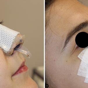 A New Modification Of Doyle Splint Hemi Split Doyle In Rhinoplasty