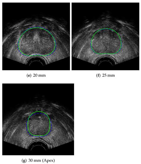 Prostate Anatomy Ultrasound