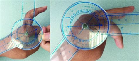 Clinical Evaluation The Mcp Joints Range Of Motion In Extension Left