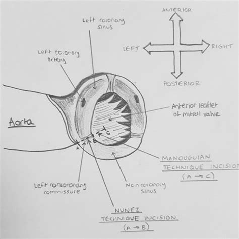 Aortic Root Enlargement When And How Request Pdf