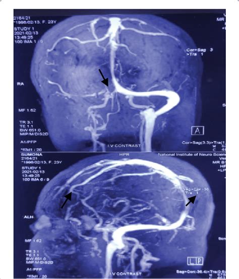 Ct Brain Showing Filling Defect In Right Transverse Sigmoid And Download Scientific Diagram