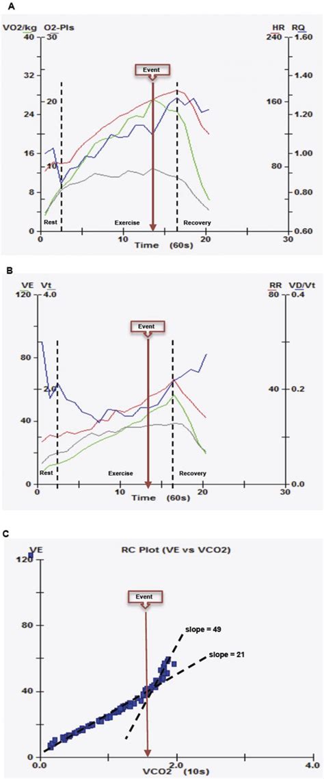 Idiopathic Left Bundle Branch Block And Unexplained Symptom At Exercise A Case Report ABC Cardiol