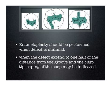 Amalgam Cavity Preparation Class I Pdf