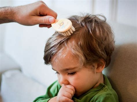 Scalp Yeast Infection Causes Symptoms And Treatments