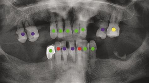 Rehabilitación Completa Sobre Implantes En El Paciente Con