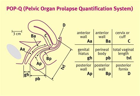 Uterine Prolapse Preservation Or Excision Obstetrics Gynaecology And Reproductive Medicine