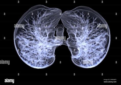 Ct Chest Or Lung 3d Rendering Image Showing Trachea And Lung In