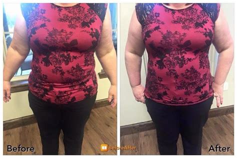 Ruby Ribbon Before After Photos Cluster Bra Free How To Wear Comfortable Bras