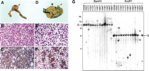 Liver Is Enlarged And Diffusely Echogenic Diffusely Heterogeneous