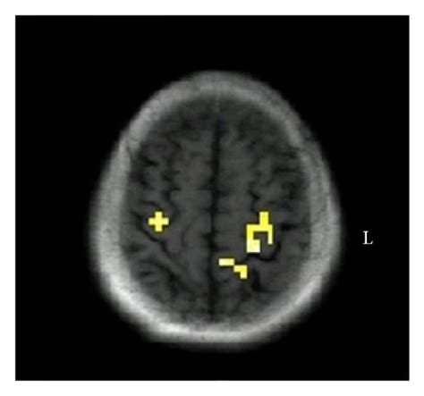 longitudinal observation of brain activation in case 4 during the