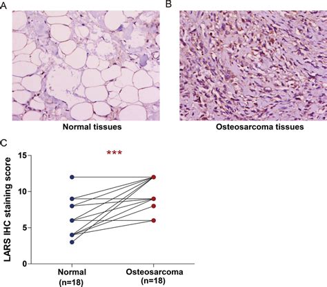 ihc analyses of lars protein expression in osteosarcoma a b