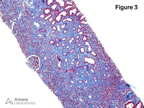Chronic Active Tubulointerstitial Nephritis Teaching Points