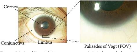 Figure 1 From Limbal Stem Cell Deficiency Special Focus On Tracking Limbal Stem Cells