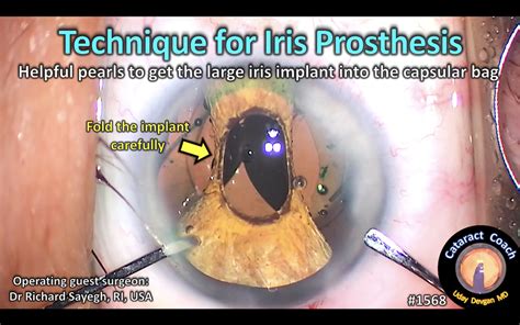 1568 Iris Prosthesis Technique Cataract Coach™