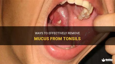 Ways To Effectively Remove Mucus From Tonsils Medshun
