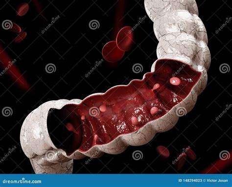 Colon Polyps 3d Illustration Polyp In The Intestine Stock Illustration Illustration Of Body