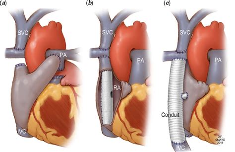 The Pulmonary Vascular Bed In Patients With Functionally Univentricular Physiology And A Fontan