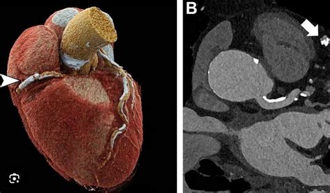 Cardiac Computed Tomography Angiography Ccta Or Cardiac Ct Scan