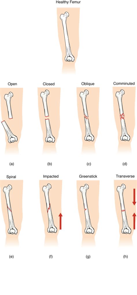 Fractures Bone Repair Anatomy Physiology