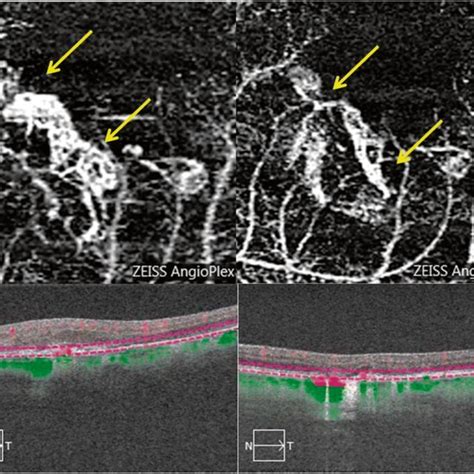 Different Patterns Of Myopic Choroidal Neovascularization Observed At
