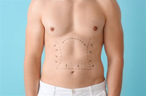 Liposuction Risks And Complications