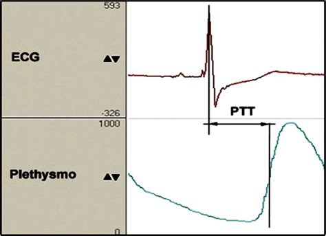 Ecg Waveform And Ppg Waveform Source Gesche Et Al Download Scientific Diagram