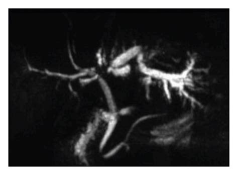Perihilar Cholangiocarcinoma A An Mrcp Image As A Focal Stricture Download Scientific