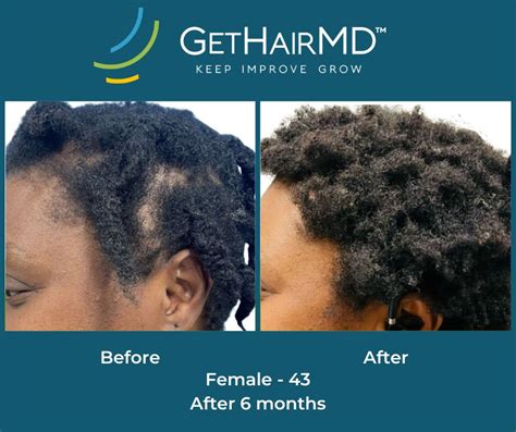 Dht Blocker In Lawrence Regain Functional Medicine And Aesthetics