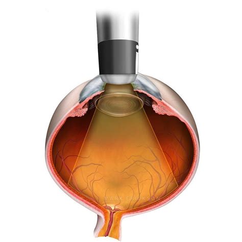 Sulcus Iol Is Positioned In The Ciliary Sulcus