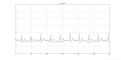 ecg信号读出，检测qrs，p，t 波（小波去噪，并根据检测），基于bp辨识的神经网络 csdn博客