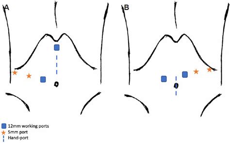 Hand Assisted Laparoscopic Approach For Right And Left Hepatectomy Download Scientific Diagram