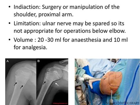 Upper Limb Blocks Ppt First Aid Injuries