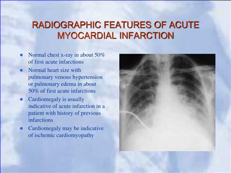 Chest X Ray For Myocardial Infarction At Elaine Baltimore Blog
