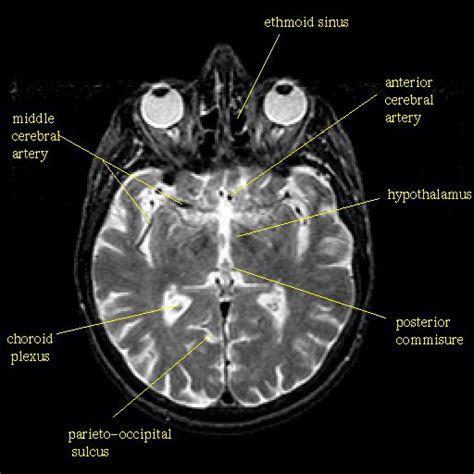 Mri Anatomy Hypothalamus At Layla Odilia Blog