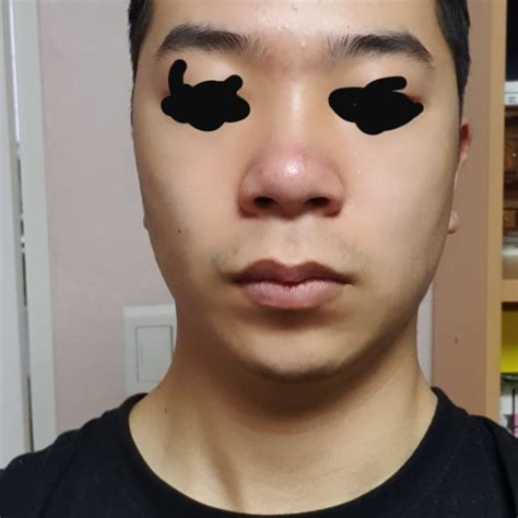 남자 코 성형 지식in