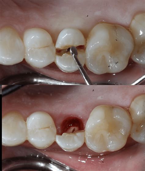 Socket Preservation Following Tooth Extraction Hands On And Live