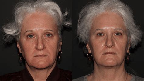 Facial Volume Loss Vancouver Shine Md
