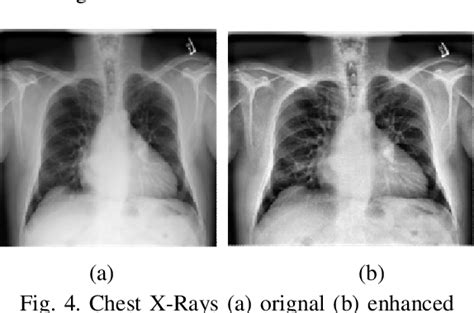 figure 4 from computer aided system for pneumothorax detection through