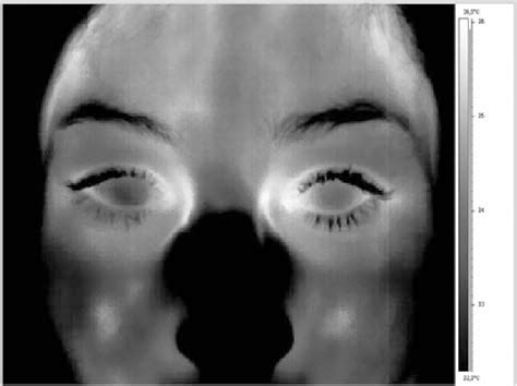 Subject 2 Bilateral Maxillary Sinusitis Contrasted Thermogram Download Scientific Diagram