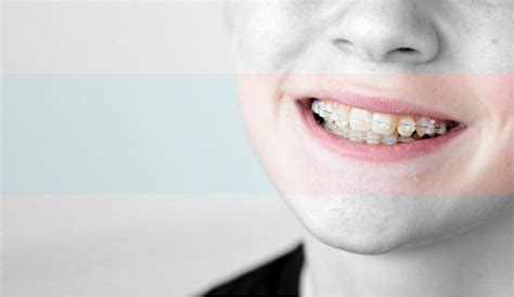 Braces Through The Ages The Evolution Of Orthodontic Care Smile