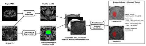 Joint Cancer Segmentation And Pi Rads Classification On Multiparametric