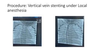 Supracardiac Tapvr With Obstructivepptx