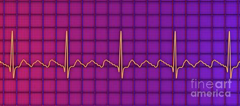 Atrial Flutter Abnormal Heartbeat Rhythm 12 By Kateryna Kon Science Photo Library